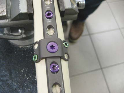 Sistem de Cerclaj Sirtalis pentru fracturile periprotetice