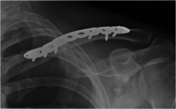 Placa de Clavicula in S