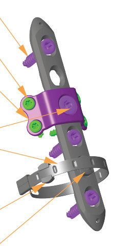 Sistem de Cerclaj Sirtalis pentru fracturile periprotetice